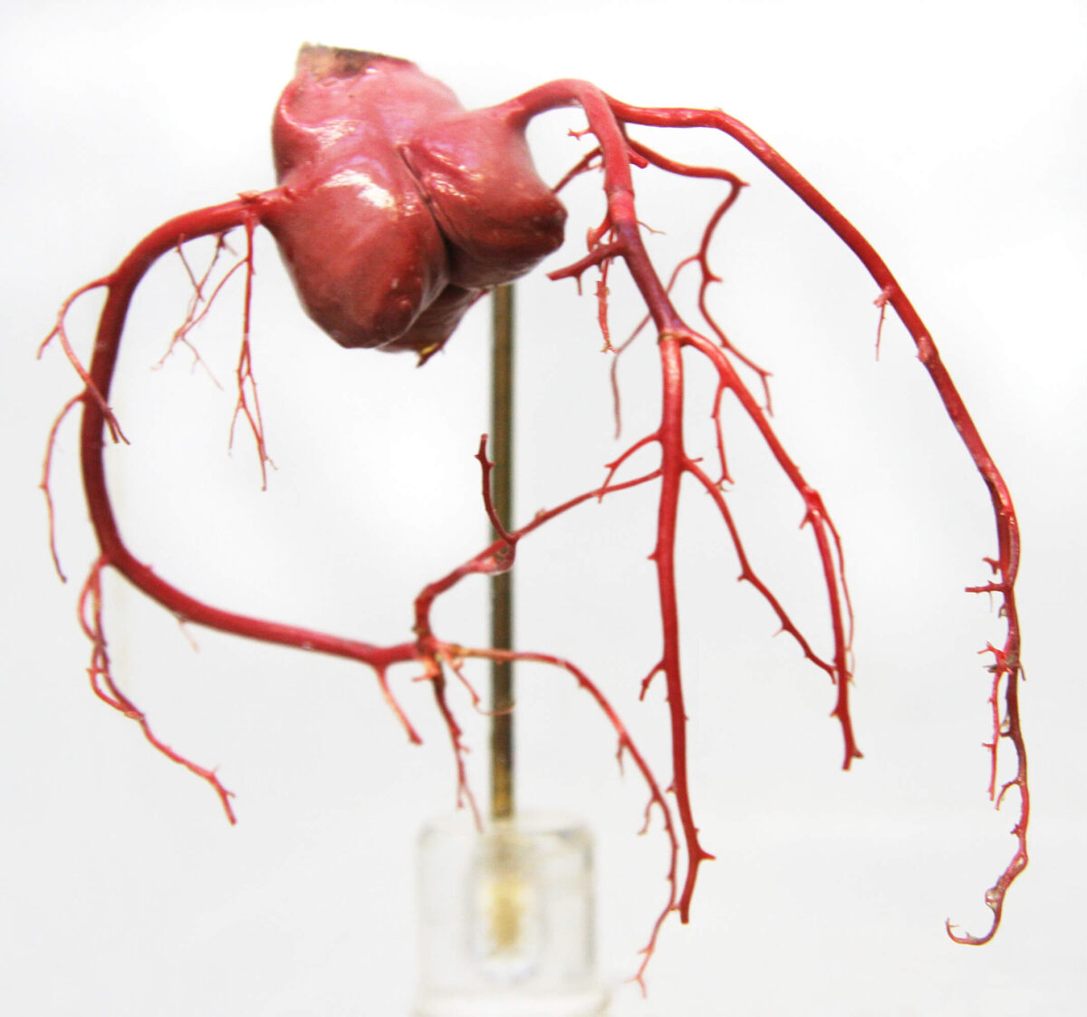 Coronary Bifurcation Lesions | Dr Raghu