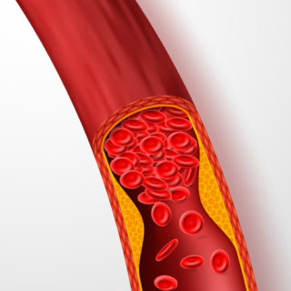 What is Thromboembolism - Symptoms, Causes, Risk factors and Treatment