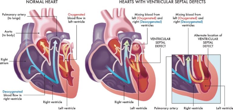 Ventricular Septal Defects - Causes, Types, and Symptoms | Dr Raghu