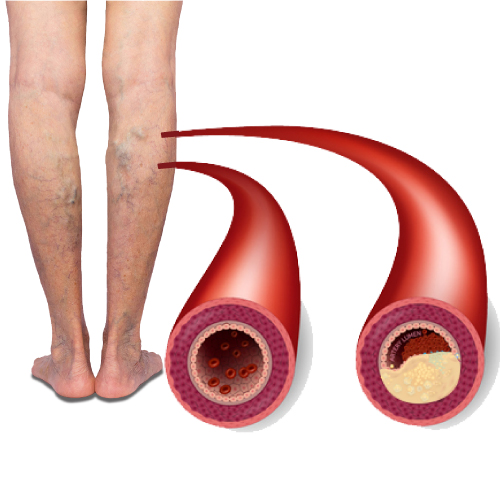 Diabetic Foot And Critical Limb Ischemia | Dr. C Raghu