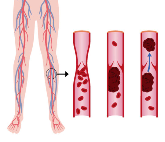 Deep Vein Thrombosis - Symptoms, Treatment, Causes and risk factors