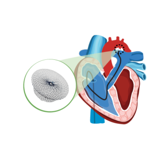 Patent Ductus Arteriosus Device Closure | Dr Raghu
