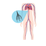 Inferior Vena Cava (IVC) Filter | Dr Raghu