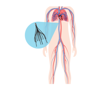Inferior Vena Cava (IVC) Filter | Dr Raghu