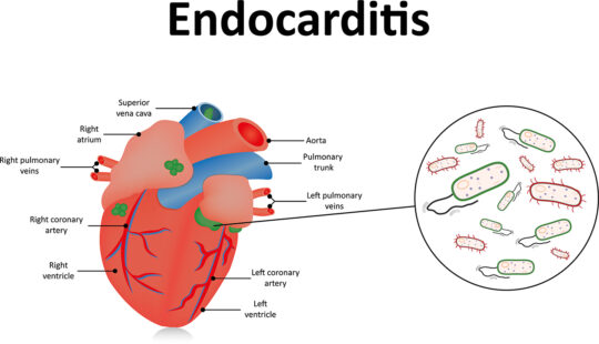 What is endocarditis? - Symptoms and Causes | Dr Raghu
