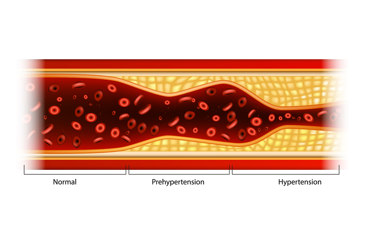 High Blood Pressure (Hypertension) Symptoms & Treatment | Dr Raghu