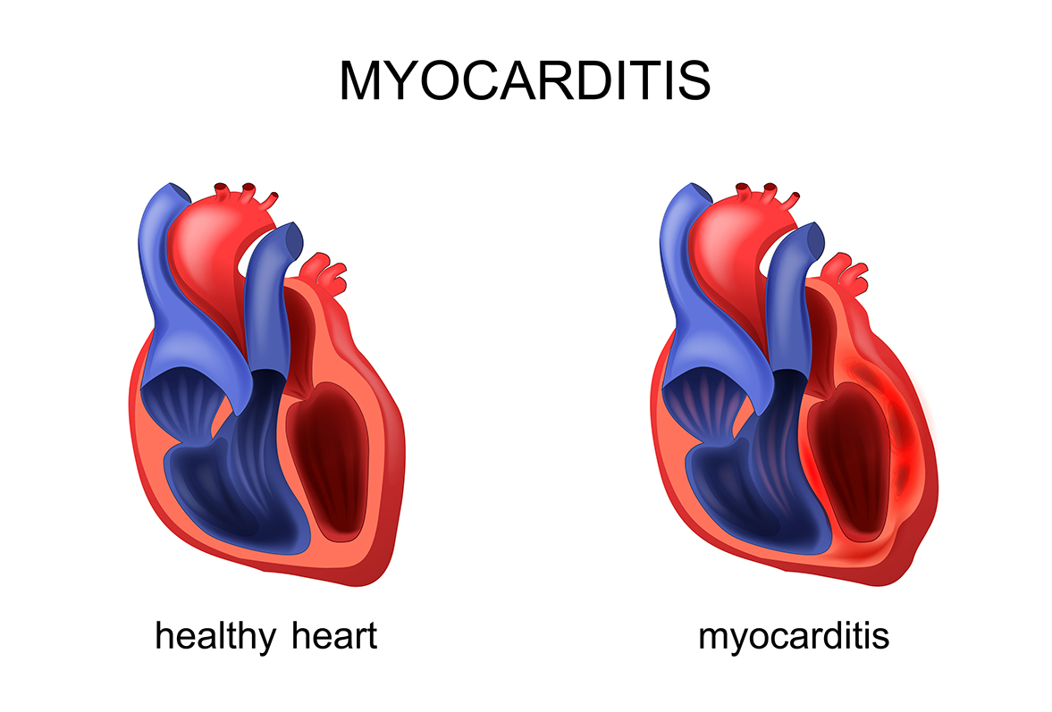 Myocarditis DrCRaghu