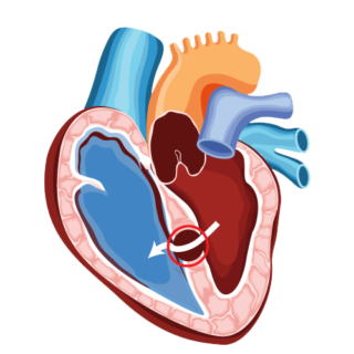 ASD Device Closure | Dr Raghu