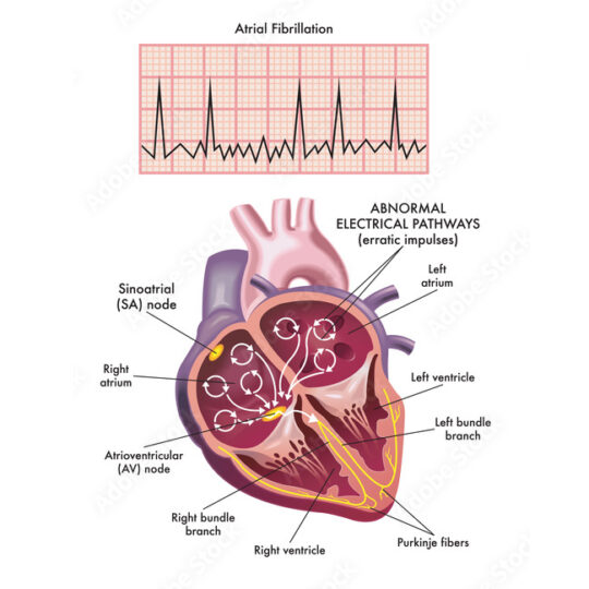 Do You Have Atrial Fibrillation and What Are Its Causes