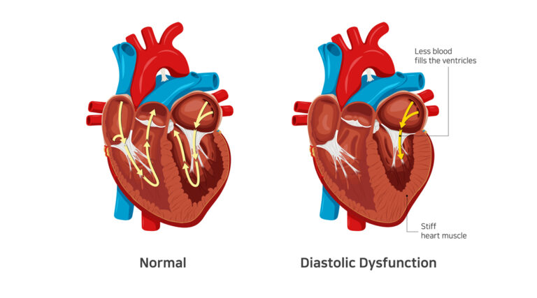 Know The Symptoms of Diastolic Dysfunction | Dr. Raghu