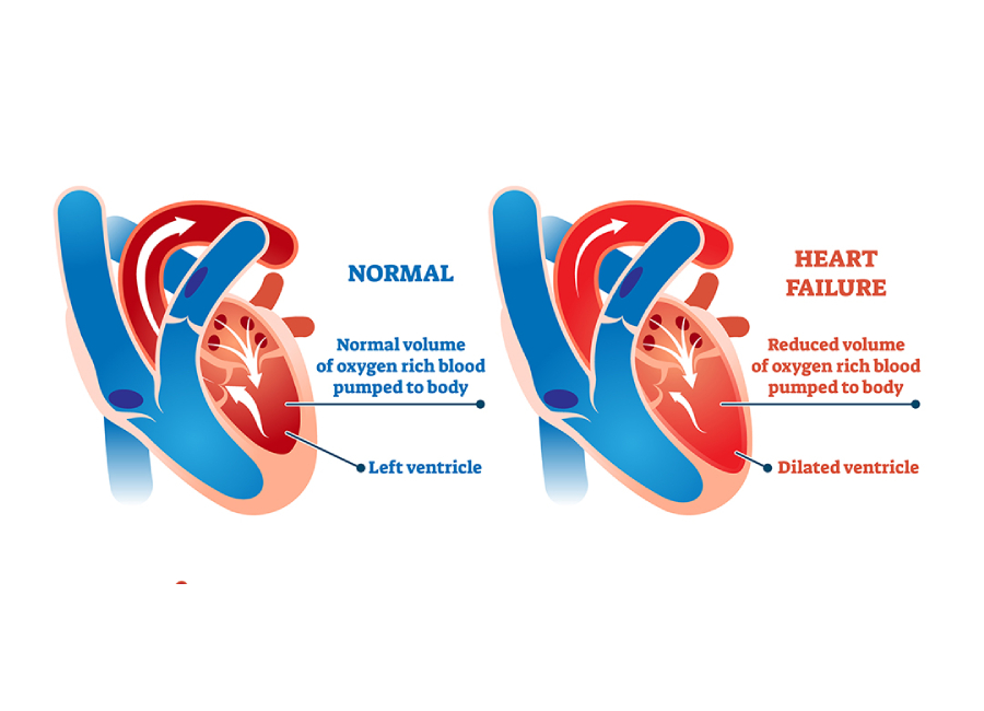 Left Sided Heart Failure Causes Symptoms And Treatment Dr Raghu