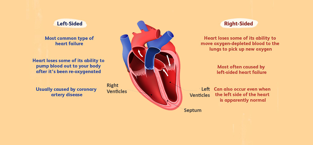 Left Sided Heart Failure Causes Symptoms And Treatment Dr Raghu