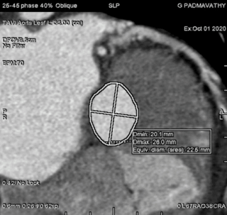 The Importance Of CT Angiogram Before TAVR | Dr. C Raghu