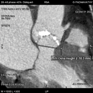 The Importance Of CT Angiogram Before TAVR | Dr. C Raghu