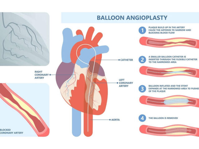 Early Stage Blood Clots Symptoms In The Heart | Dr. Raghu