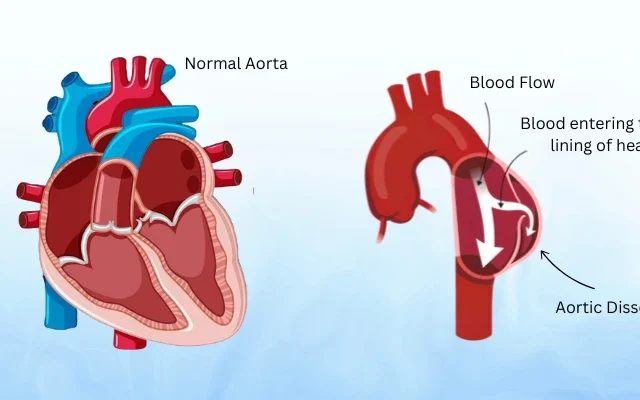 Mild Heart Attack: How Serious Is It? Know Treatment | Dr. C Raghu
